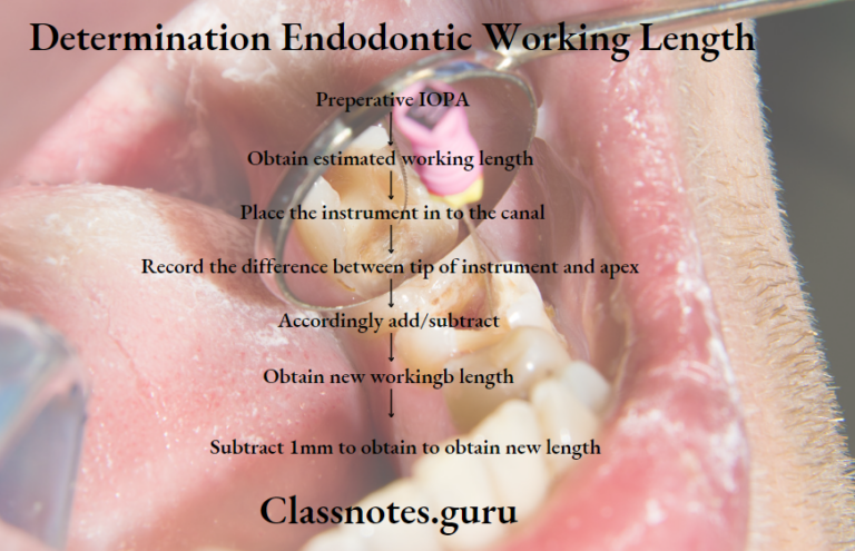 Determination Endodontic Working Length - Class Notes