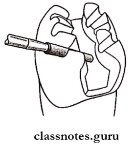 Cavity Preparation For Cast Metal Restorations Question And Answers ...