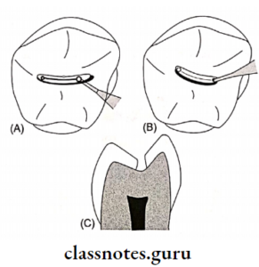 Composite Restoration Question And Answers - Class Notes