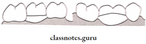 Fixed Partial Denture - Class Notes