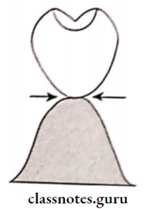 Fixed Partial Denture - Class Notes