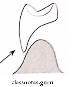 Fixed Partial Denture - Class Notes