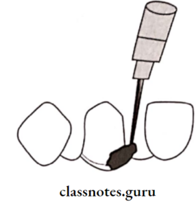 Fixed Partial Denture - Class Notes