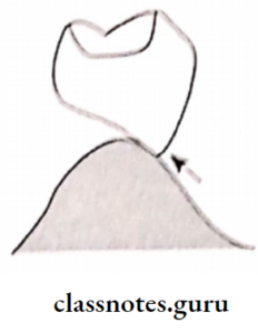 Fixed Partial Denture - Class Notes