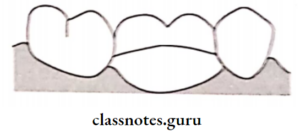 Fixed Partial Denture - Class Notes