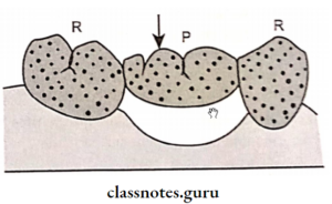 Fixed Partial Denture - Class Notes