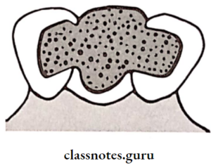 Fixed Partial Denture - Class Notes
