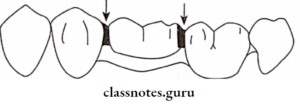 Fixed Partial Denture - Class Notes
