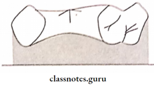 Fixed Partial Denture - Class Notes
