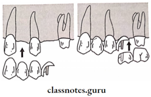 Fixed Partial Denture - Class Notes