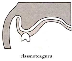 Prosthodontics Archives - Class Notes