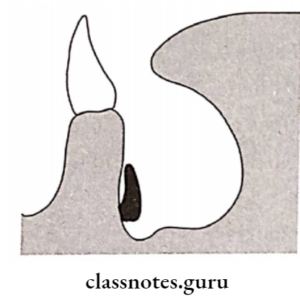 Removable Partial Dentures Long Essays - Class Notes