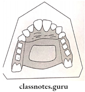 Removable Partial Dentures Long Essays - Class Notes