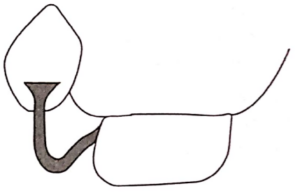 Removable Partial Dentures Long Essays - Class Notes