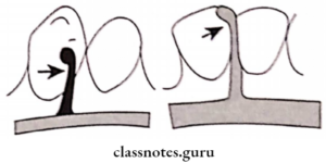 Removable Partial Dentures Short Answers - Class Notes