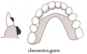 Removable Partial Dentures Long Essays - Class Notes