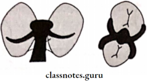 Removable Partial Dentures Long Essays - Class Notes