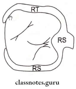 Removable Partial Dentures Long Essays - Class Notes