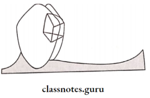 Removable Partial Dentures Short Answers - Class Notes