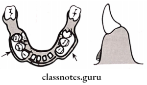 Removable Partial Dentures Long Essays - Class Notes