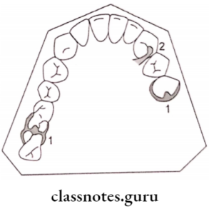 Removable Partial Dentures Long Essays - Class Notes