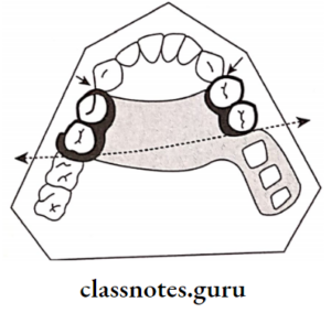 Removable Partial Dentures Long Essays - Class Notes