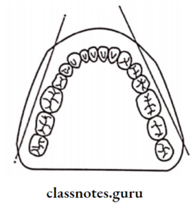 Removable Partial Dentures - Class Notes