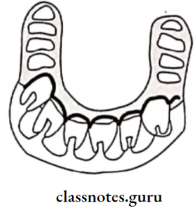 Removable Partial Dentures - Class Notes