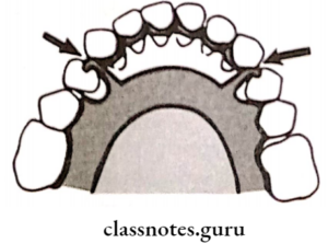Removable Partial Dentures Long Essays - Class Notes