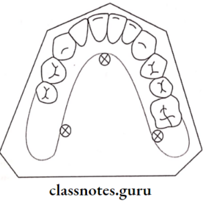 Removable Partial Dentures Long Essays - Class Notes