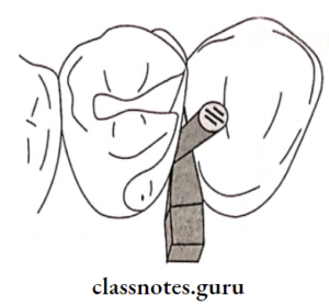 Matricing And Tooth Separation Question And Answers - Class Notes