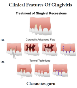 Clinical Features Of Gingivitis - Class Notes