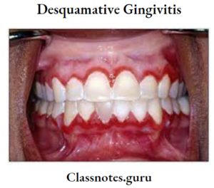 Desquamative Gingivitis - Class Notes