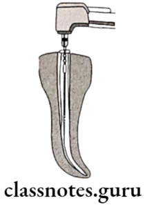 Obturation Of Root Canal Question And Answers - Class Notes