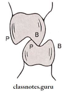 Fixed Partial Denture - Class Notes