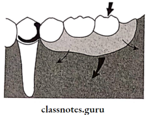 Fixed Partial Denture - Class Notes