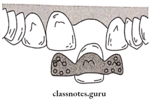Fixed Partial Denture - Class Notes