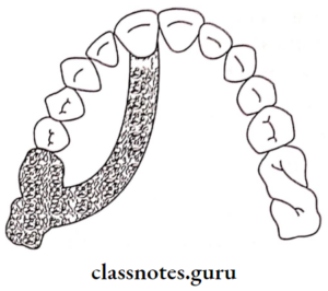 Fixed Partial Denture - Class Notes