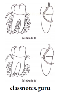 Furcation Involvement - Class Notes