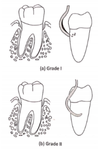 Furcation Involvement - Class Notes