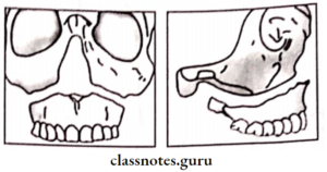 Maxillofacial Trauma - Class Notes
