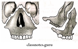 Maxillofacial Trauma - Class Notes