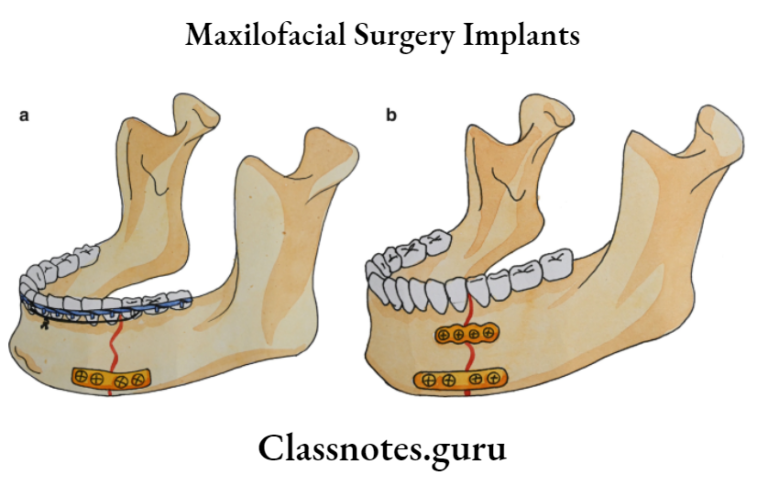 Maxilofacial Surgery Miscellaneous Question And Answers - Class Notes