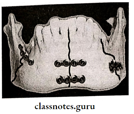 Maxilofacial Surgery Miscellaneous Question And Answers - Class Notes