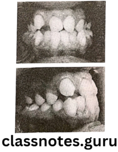 Classification Of Malocclusion Question And Answers - Class Notes