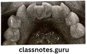 Classification Of Malocclusion Question And Answers - Class Notes
