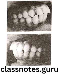 Classification Of Malocclusion Question And Answers - Class Notes