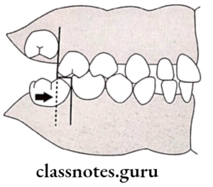 Development Of Dentition And Occlusion Question And Answers - Class Notes