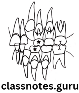 Interceptive In Orthodontics Question And Answers - Class Notes