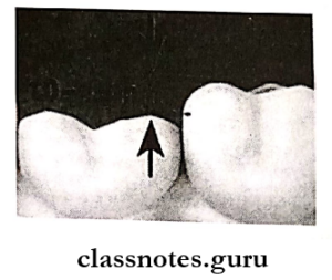 Pediatric Restorative Dentistry Question And Answers - Class Notes